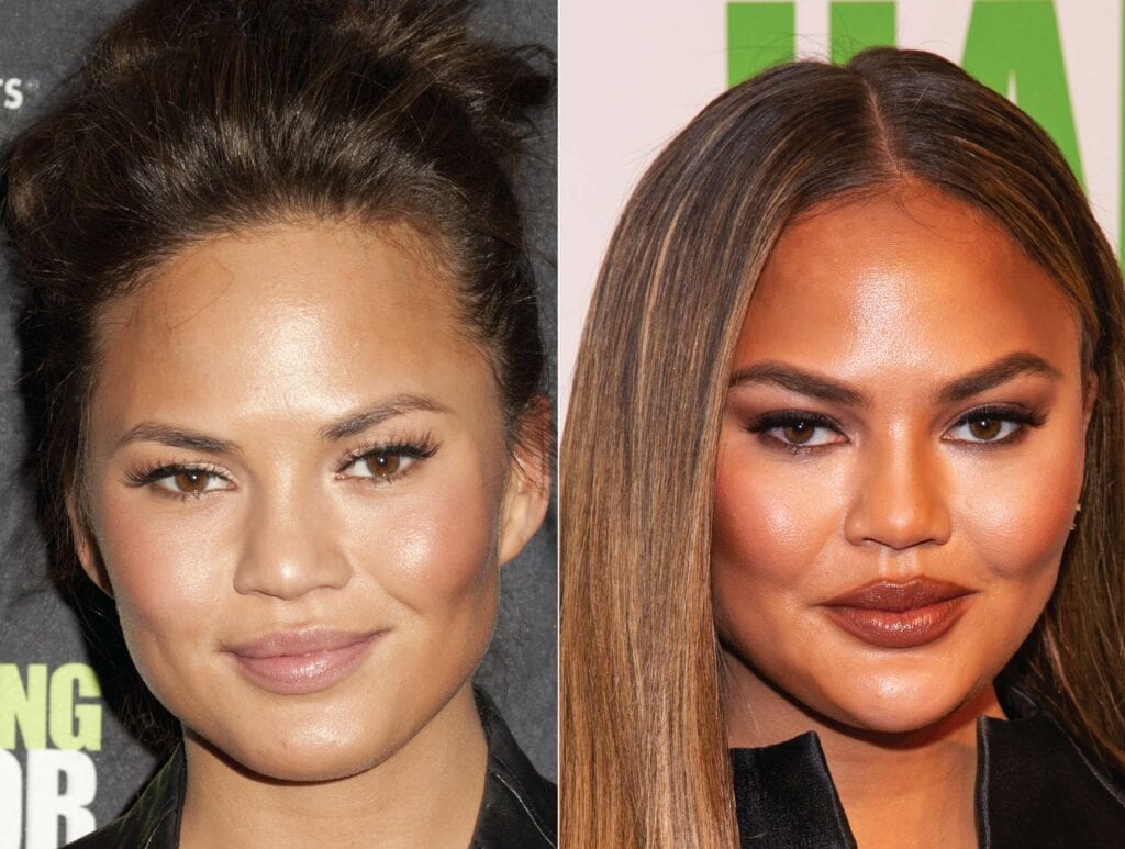 Amy Schumer Gets the Fillers in Her Face Dissolved | Lipstick Alley